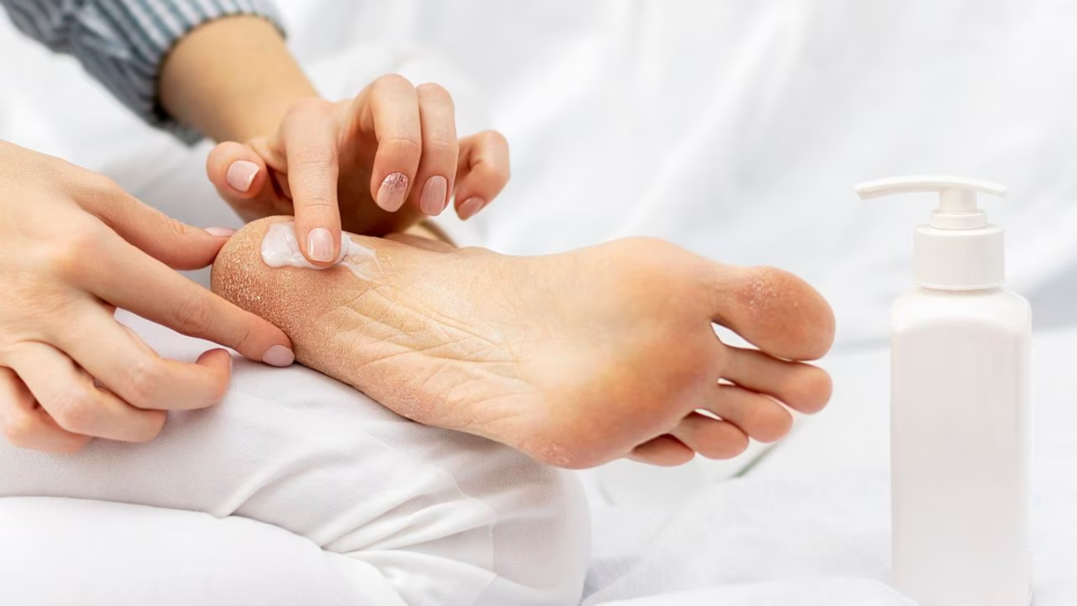 Los callos y callosidades trae molestias constantes en los pies ...